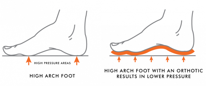 High Arches vs. Low Arches | Kintec: Footwear + Orthotics