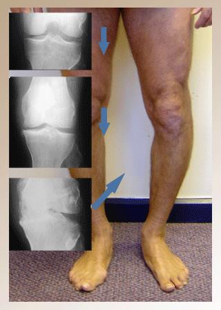 Knee Osteoarthritis (Degenerative Arthritis) | Kintec